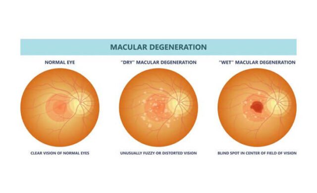 Macular Degeneration Eye Disease Treatment – A Complete Guide