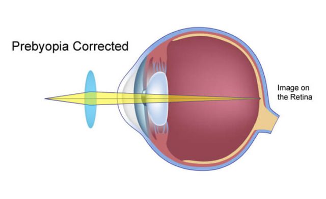 PresbyLASIK: Advanced Laser Vision Correction for Presbyopia Treatment